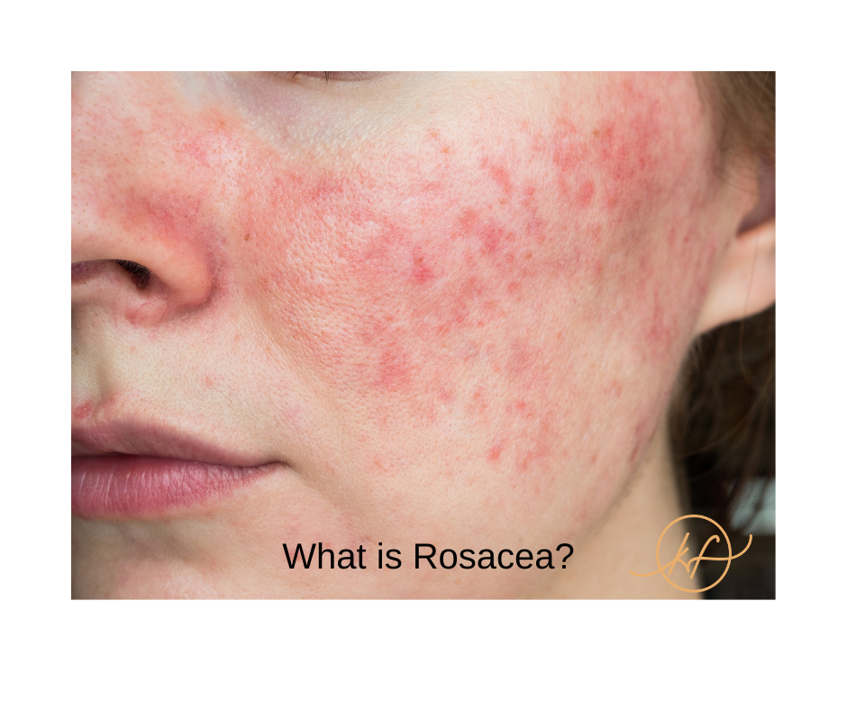 Acne Rosacea and SIBO – Katrina Froome Naturopathy